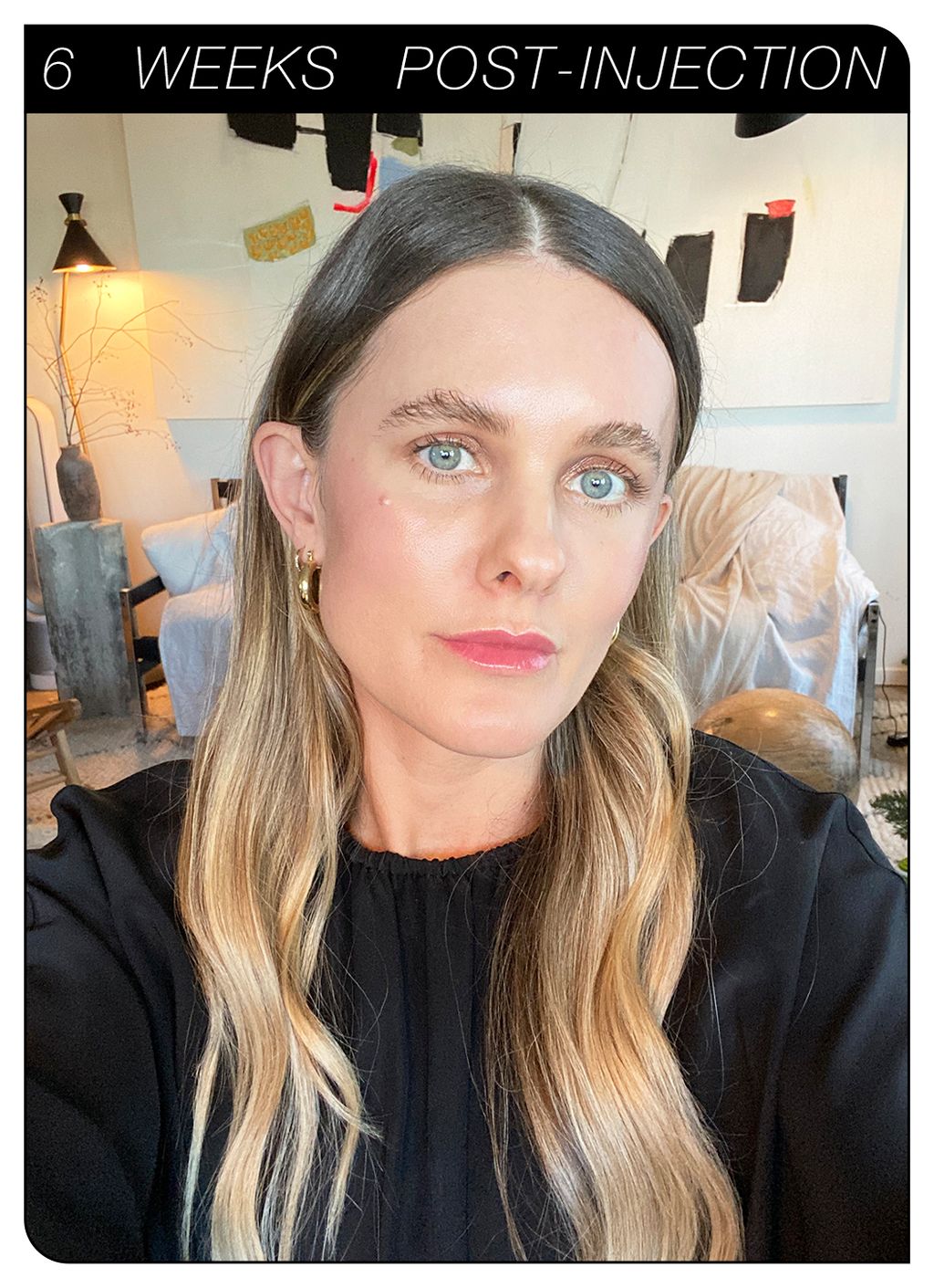 Keyhole Lip Filler: What It Is and What to Expect | Who What Wear