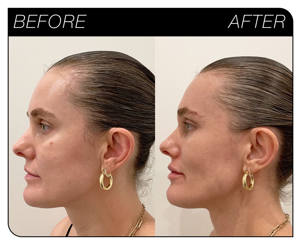 Keyhole Lip Filler: What It Is and What to Expect | Who What Wear