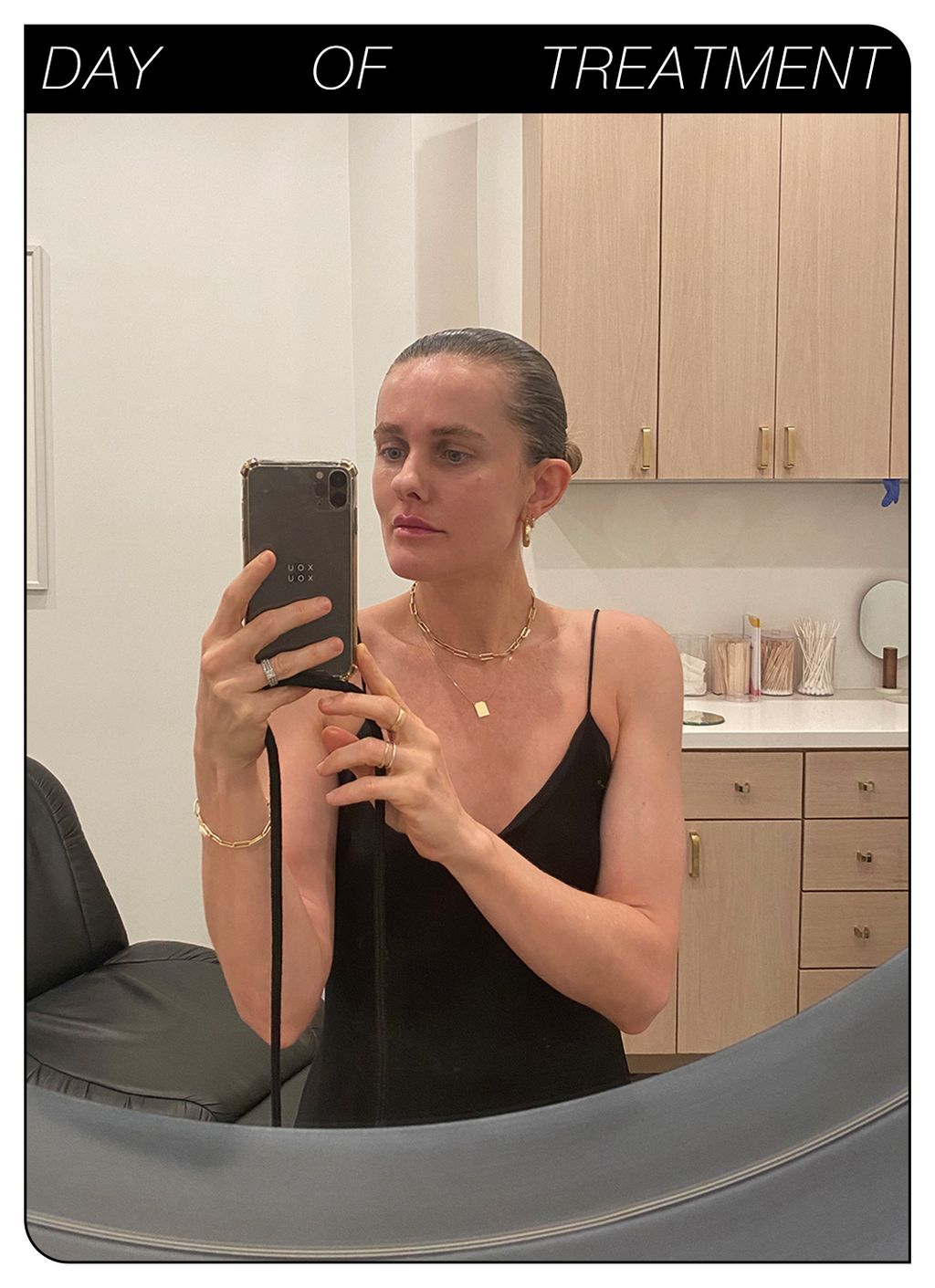 Keyhole Lip Filler: What It Is and What to Expect | Who What Wear