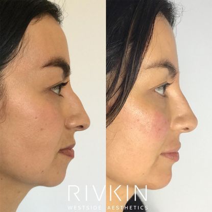 Nonsurgical Nose Jobs: Here's Everything You Should Know | Who What Wear