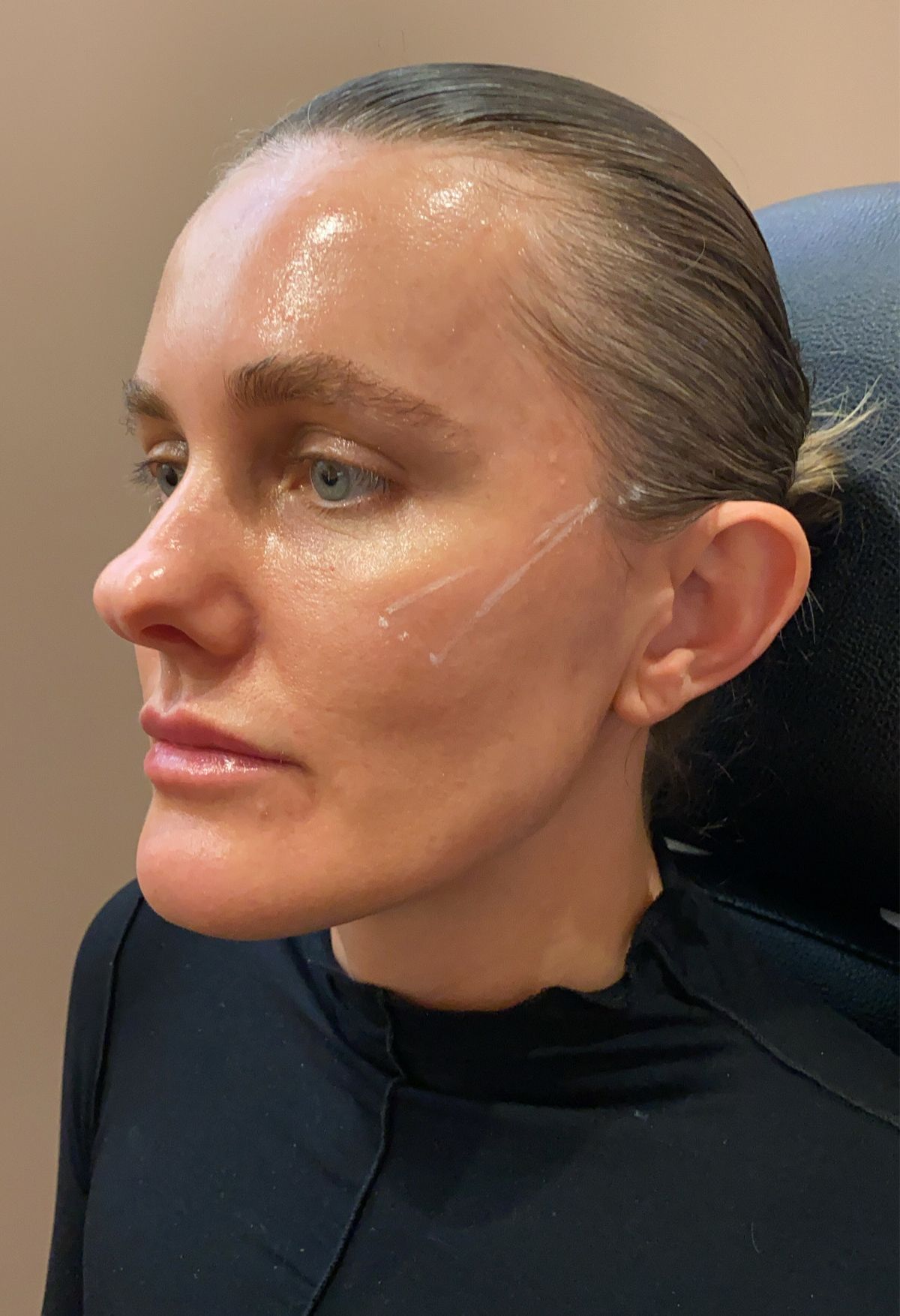 Everything You Need to Know About Thread Lifts | Who What Wear UK