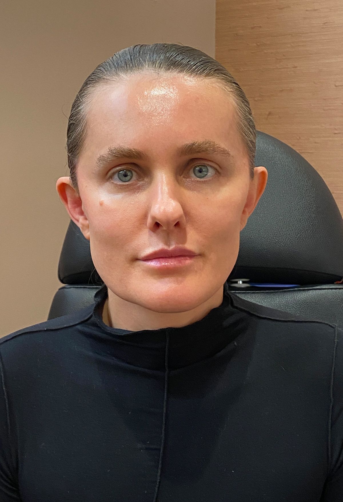 Everything You Need to Know About Thread Lifts | Who What Wear