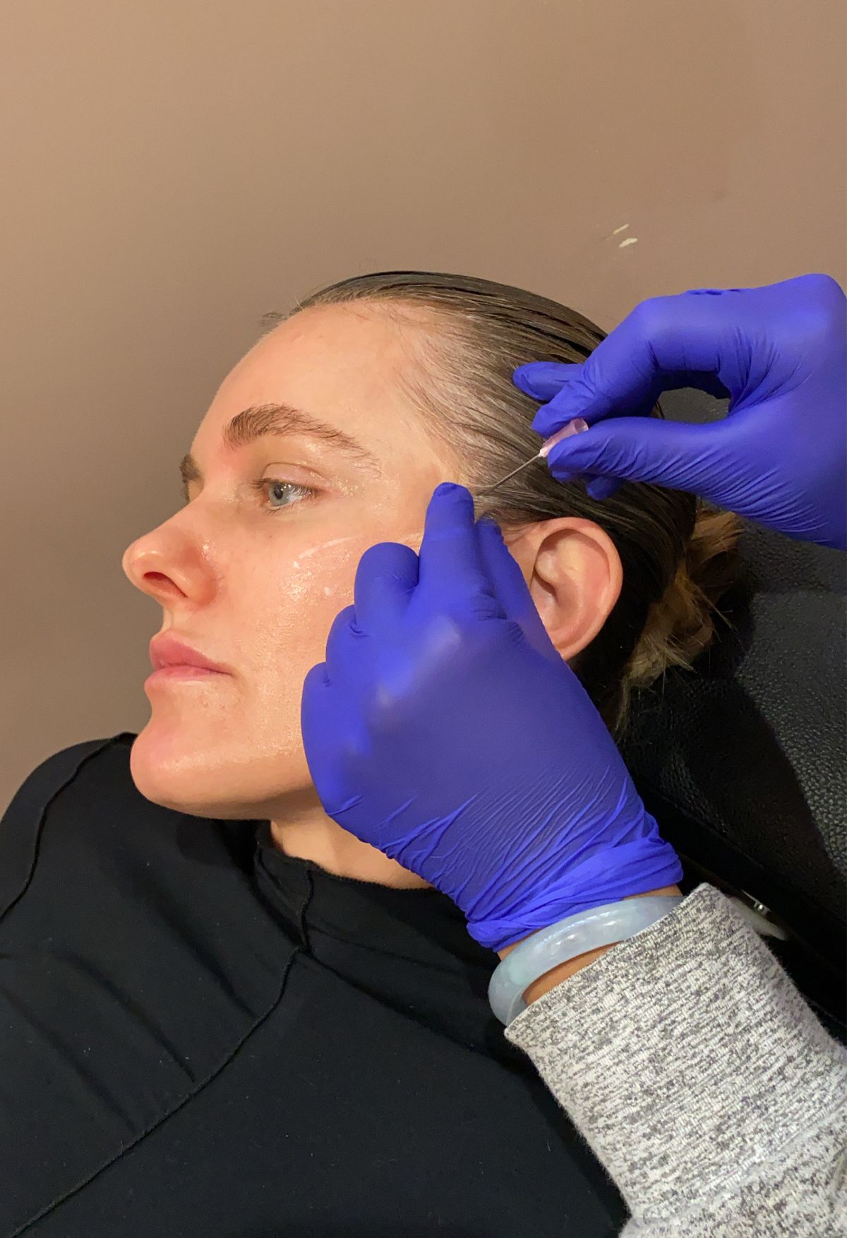 Everything You Need to Know About Thread Lifts | Who What Wear