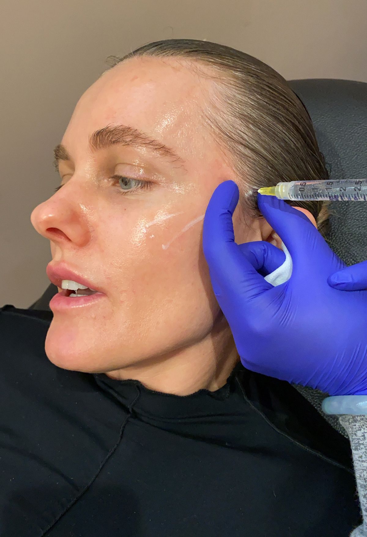 Everything You Need to Know About Thread Lifts | Who What Wear