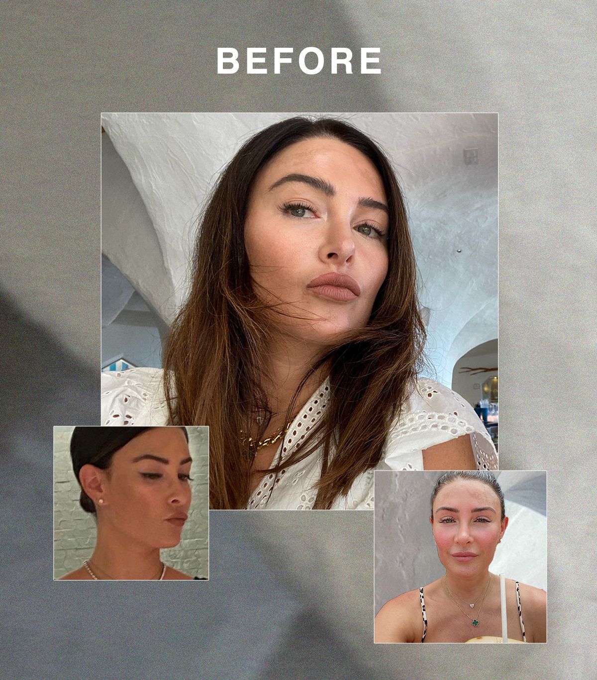 Reviewed: Cosmelan MD Peel for Melasma | Who What Wear