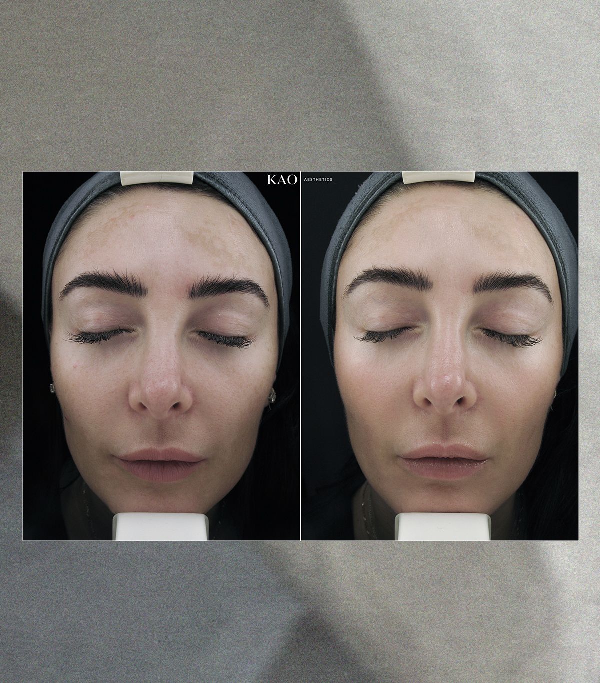 Reviewed: Cosmelan MD Peel for Melasma | Who What Wear