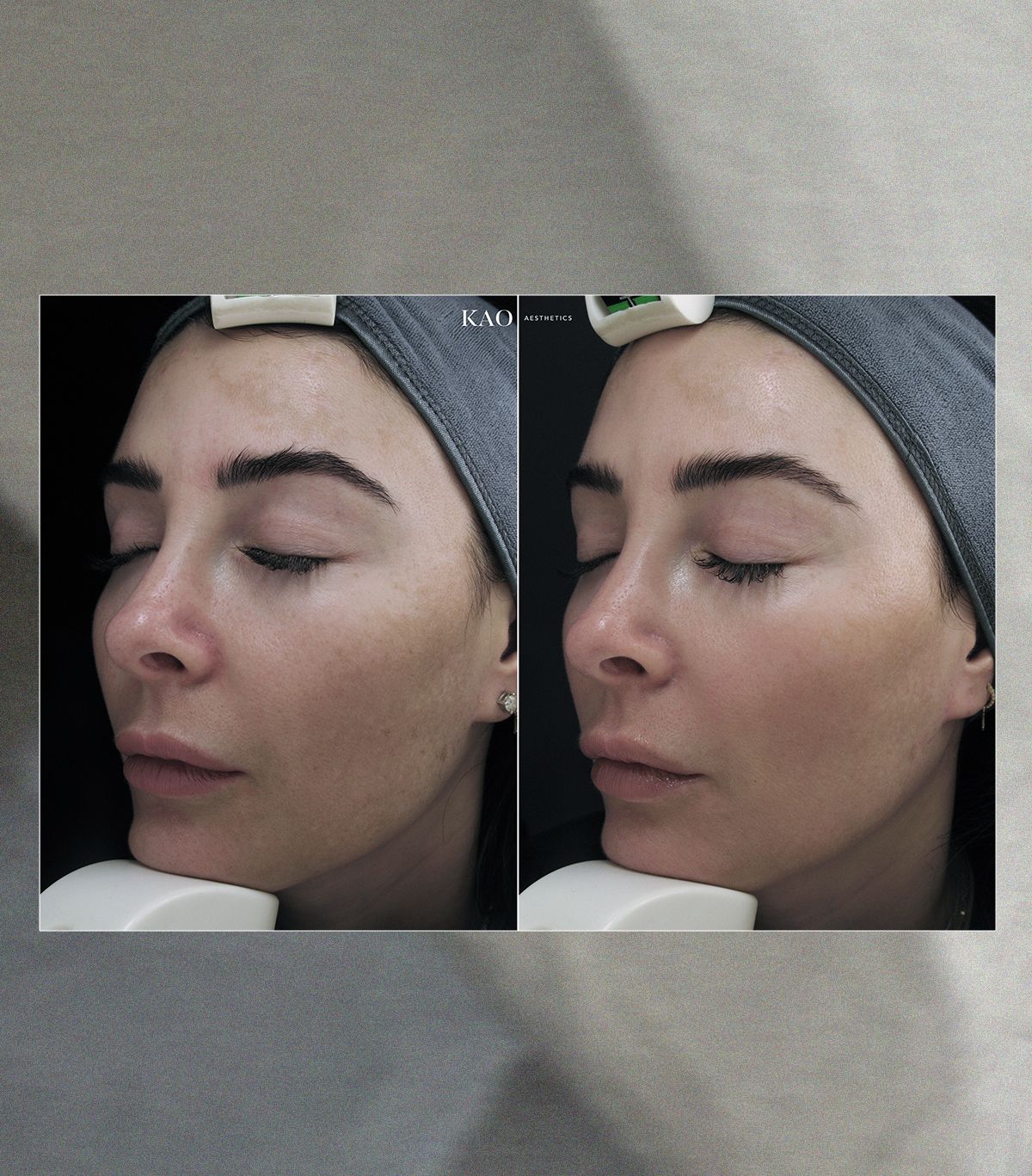 Reviewed: Cosmelan MD Peel for Melasma | Who What Wear