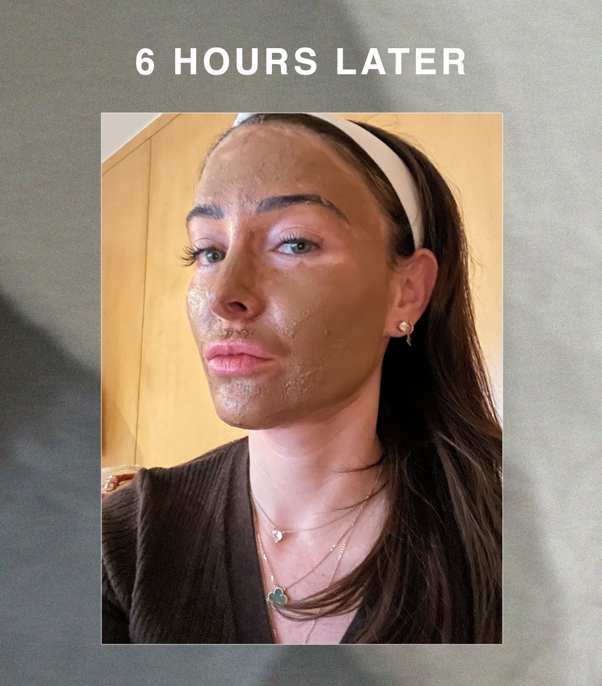 Reviewed: Cosmelan MD Peel for Melasma | Who What Wear