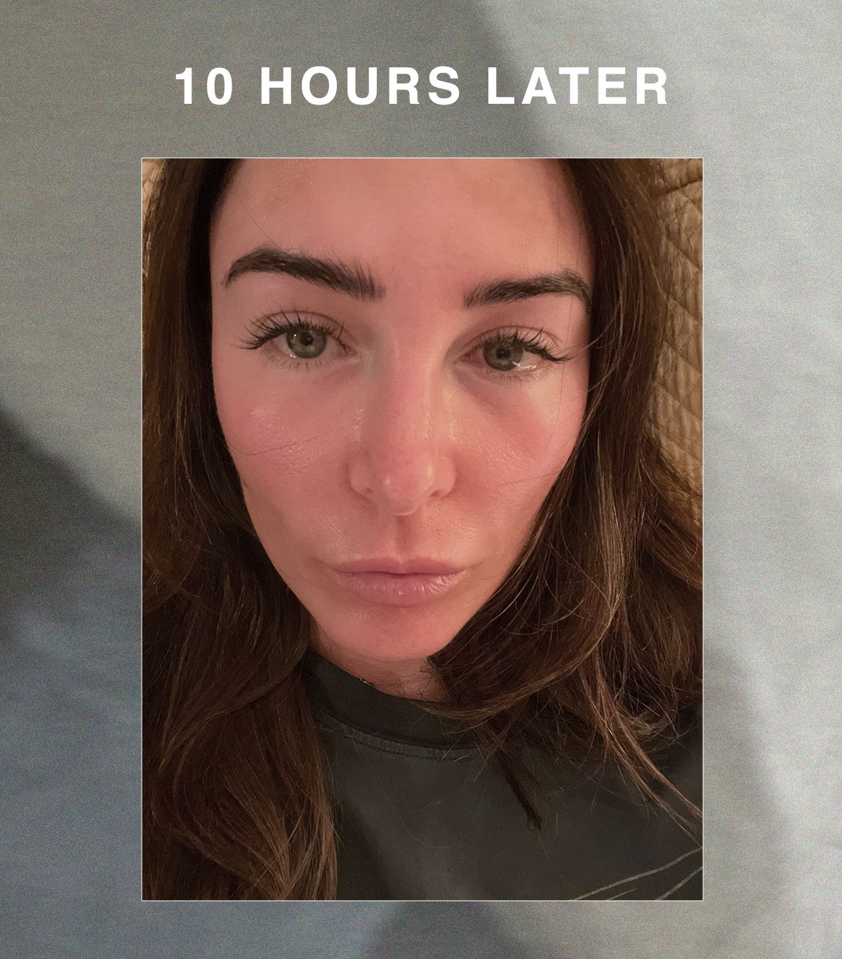 Reviewed: Cosmelan MD Peel for Melasma | Who What Wear