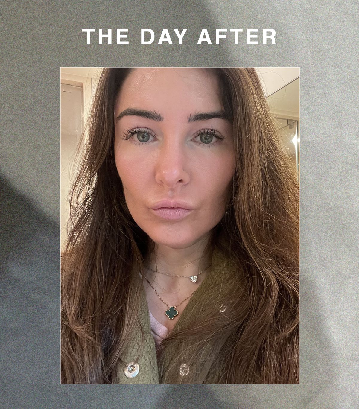 Reviewed: Cosmelan MD Peel for Melasma | Who What Wear