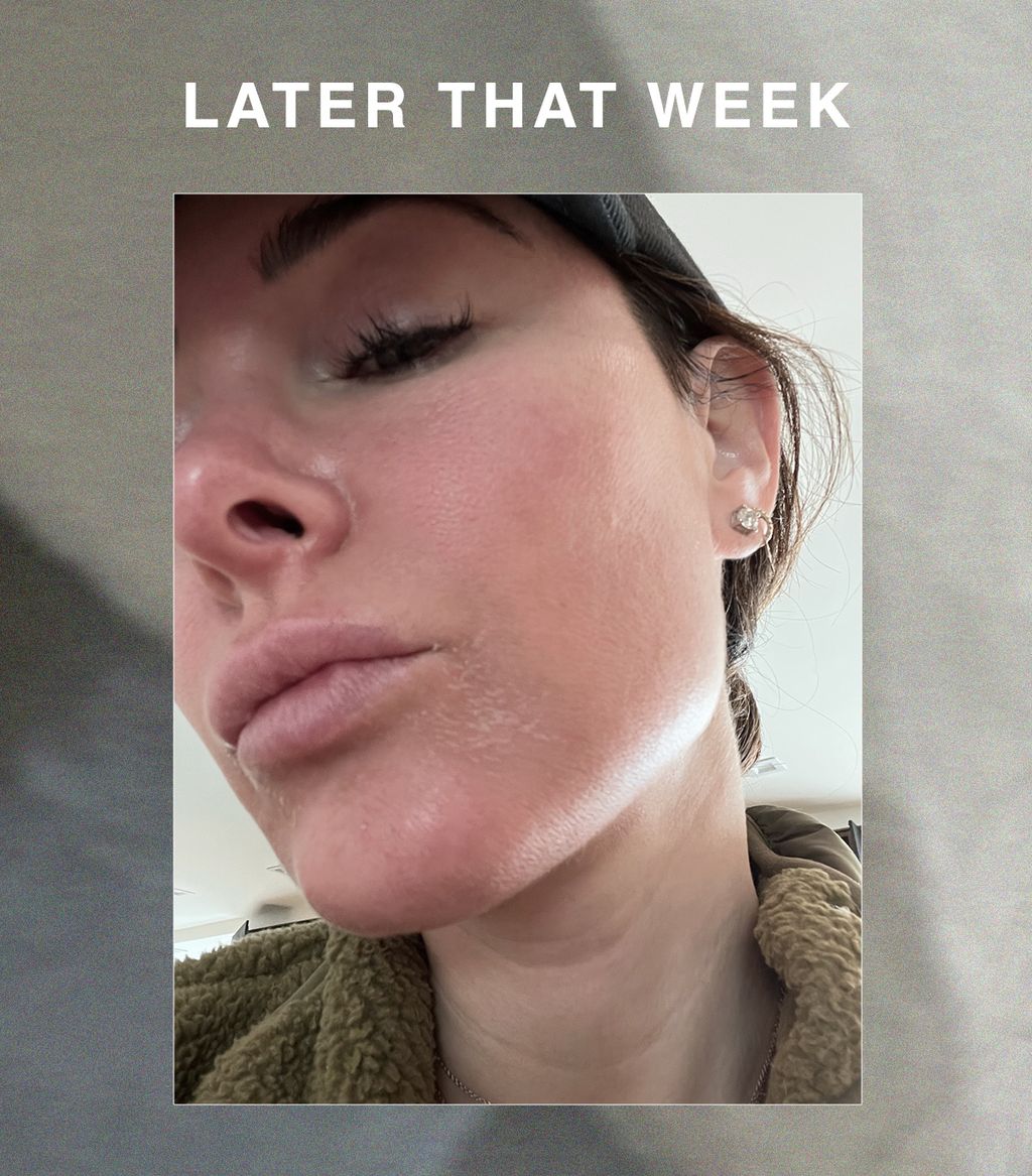 Reviewed: Cosmelan MD Peel for Melasma | Who What Wear