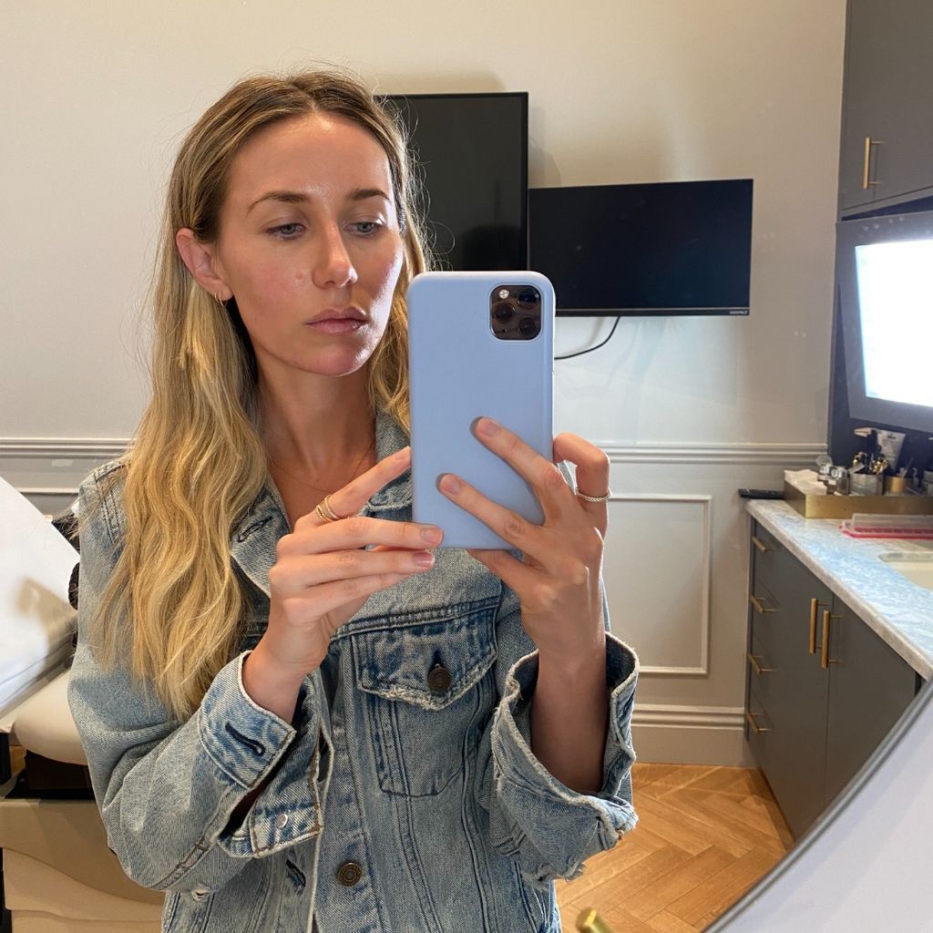 The Best Filler Tips to Know Before Treatment | Who What Wear