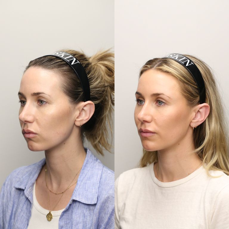 The Best Filler Tips to Know Before Treatment | Who What Wear