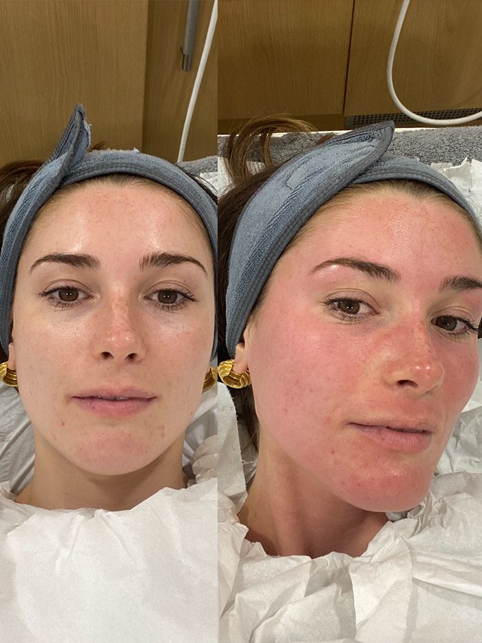 I Tried Radiofrequency Microneedling—Here's My Honest Review With ...