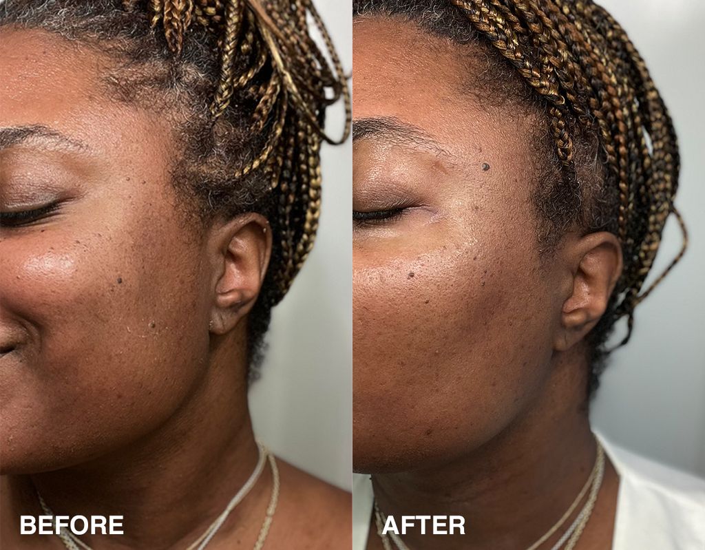 An Honest Review of Dermaflash's Dermaplaning Tools | Who What Wear