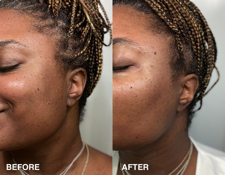 An Honest Review of Dermaflash's Dermaplaning Tools | Who What Wear