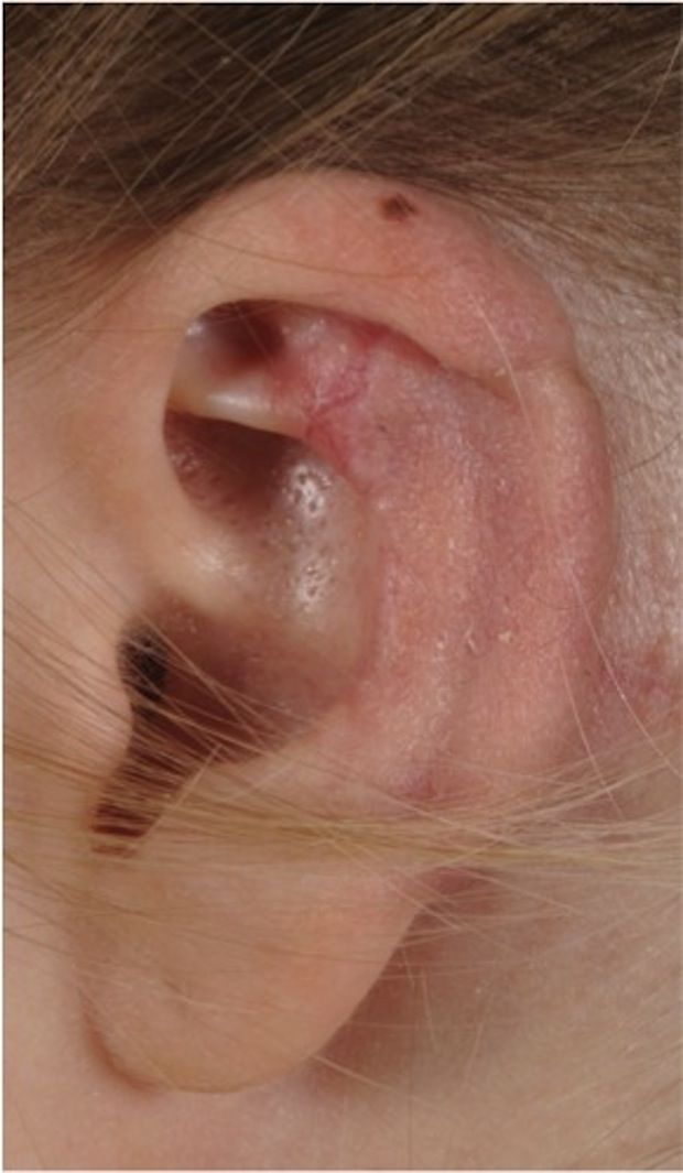 Recluse-Spider Bite Eats Hole in Young Woman's Ear | Live Science
