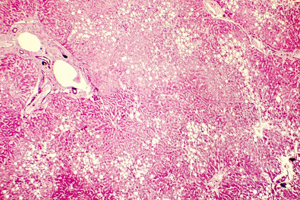 Liver: Function, failure & disease | Live Science