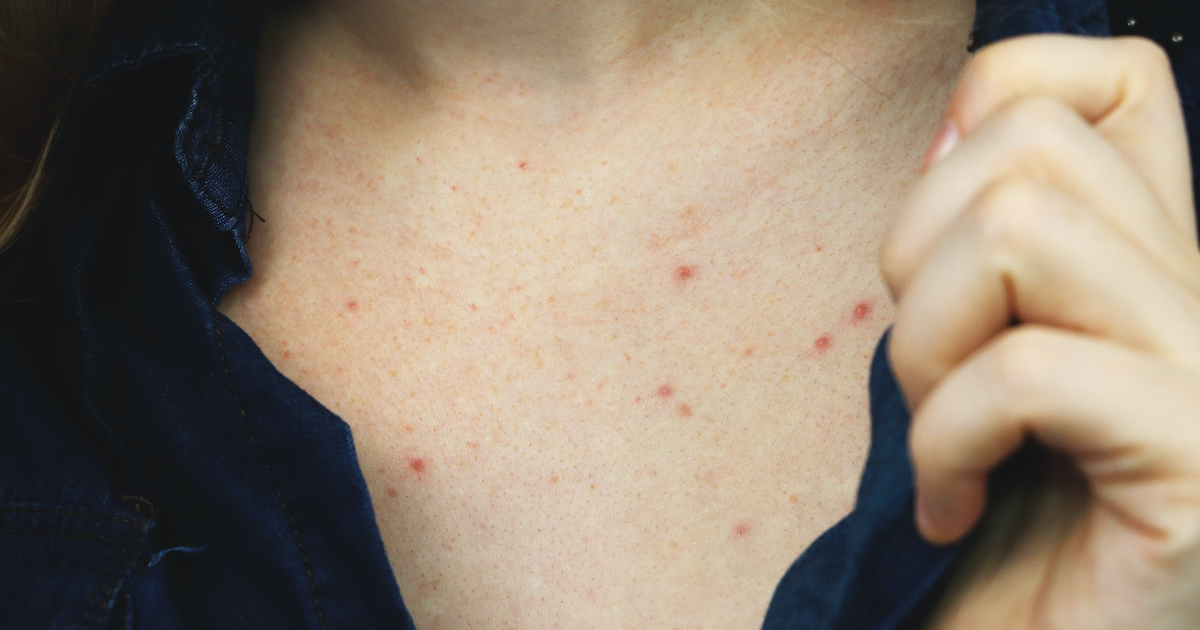 How to get rid of chest acne: Everything you need to know | Marie Claire UK