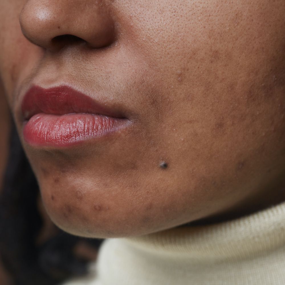 How to get rid of chin acne, according to skin experts | Marie Claire UK
