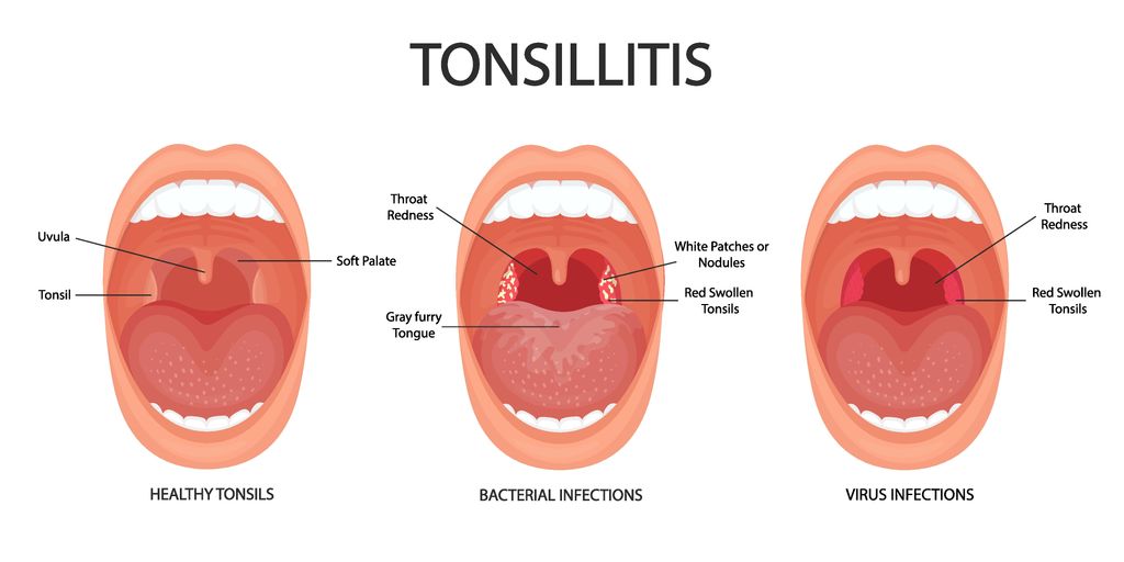 Tonsils: Definition, anatomy & function | Live Science