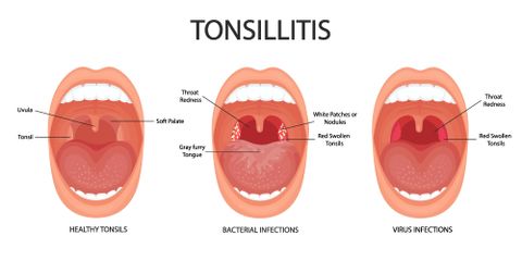 Tonsils: Definition, anatomy & function | Live Science