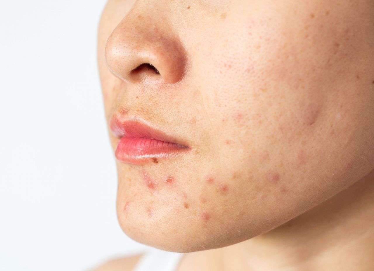How to get rid of spots and what spots on different areas of your face ...