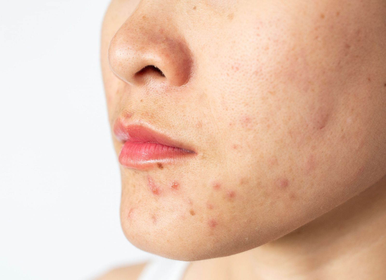 How to get rid of spots and what spots on different areas of your face ...