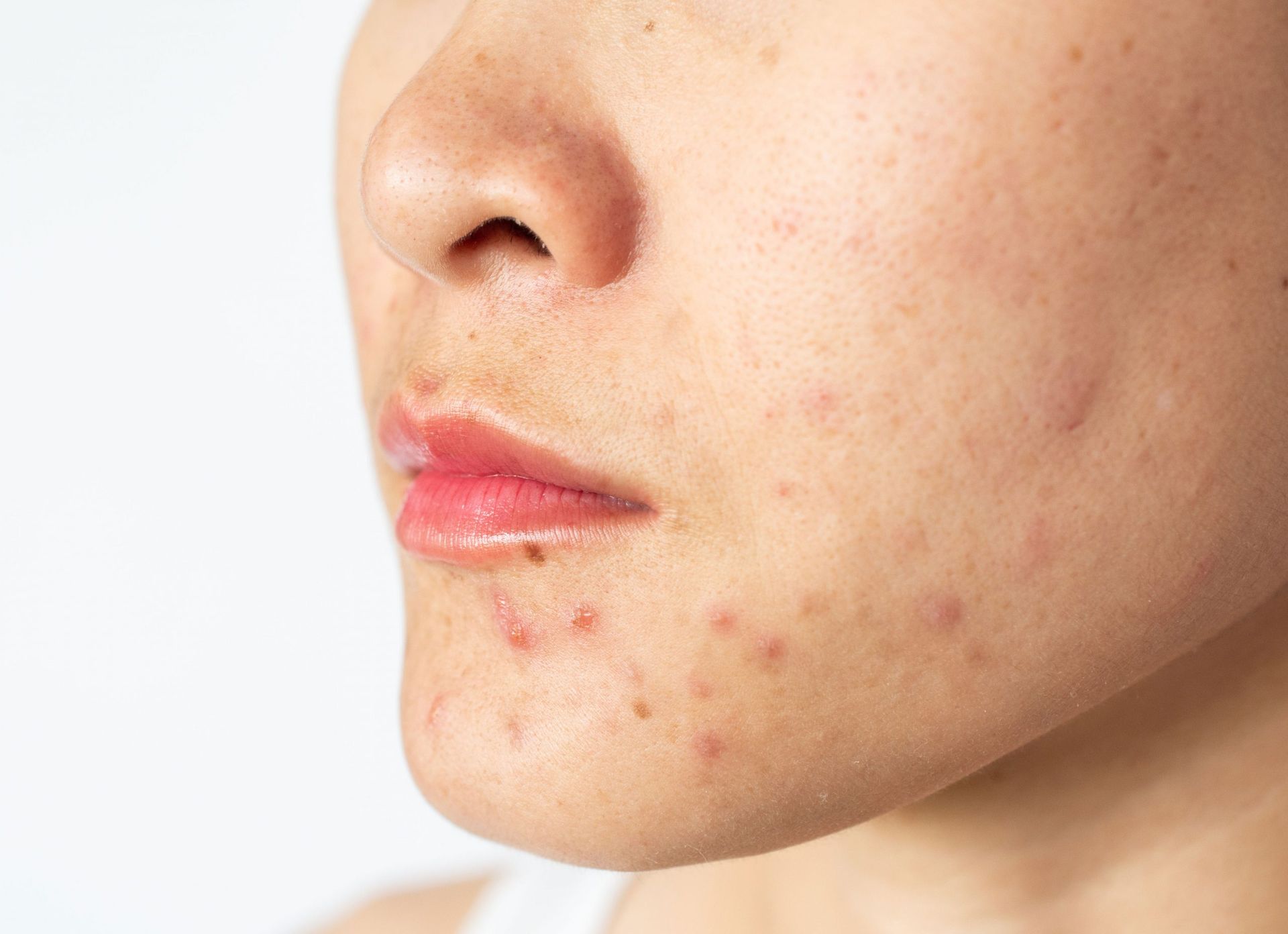 How to get rid of spots and what spots on different areas of your face ...