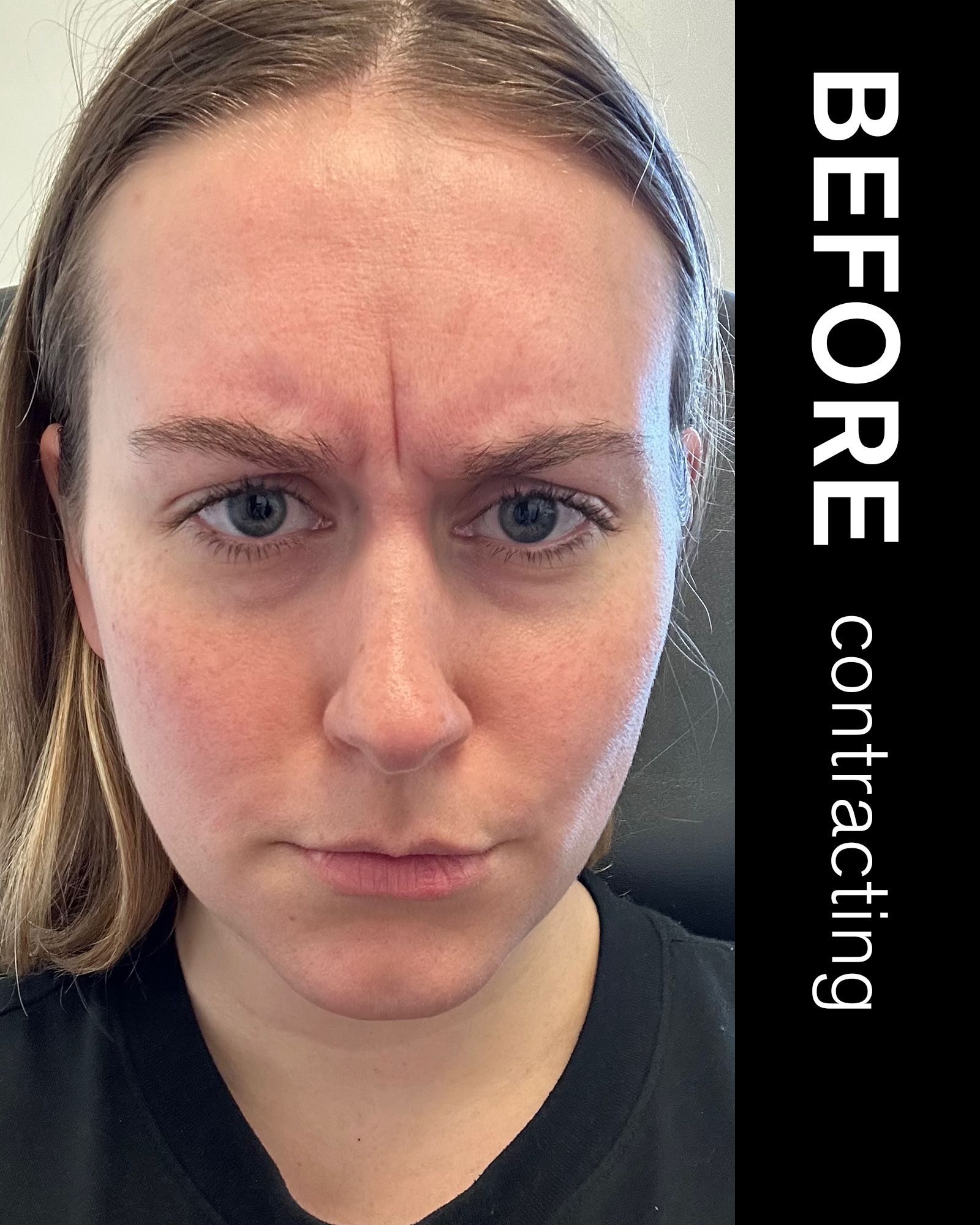 I Got Botox for the First Time—Here's What You Need to Know | Who What Wear