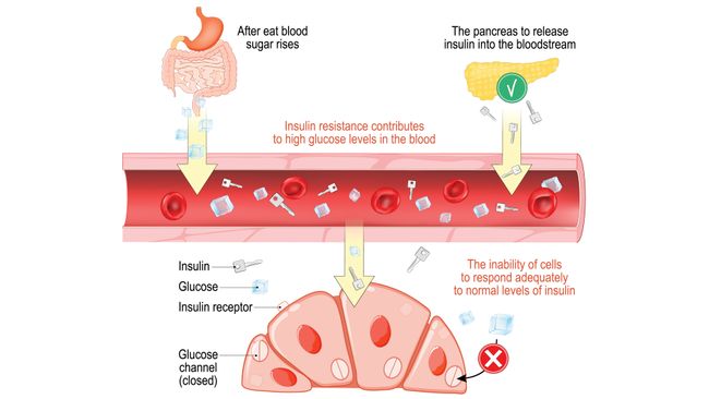 Insulin resistance: Risk factor for heart disease and diabetes | Live ...
