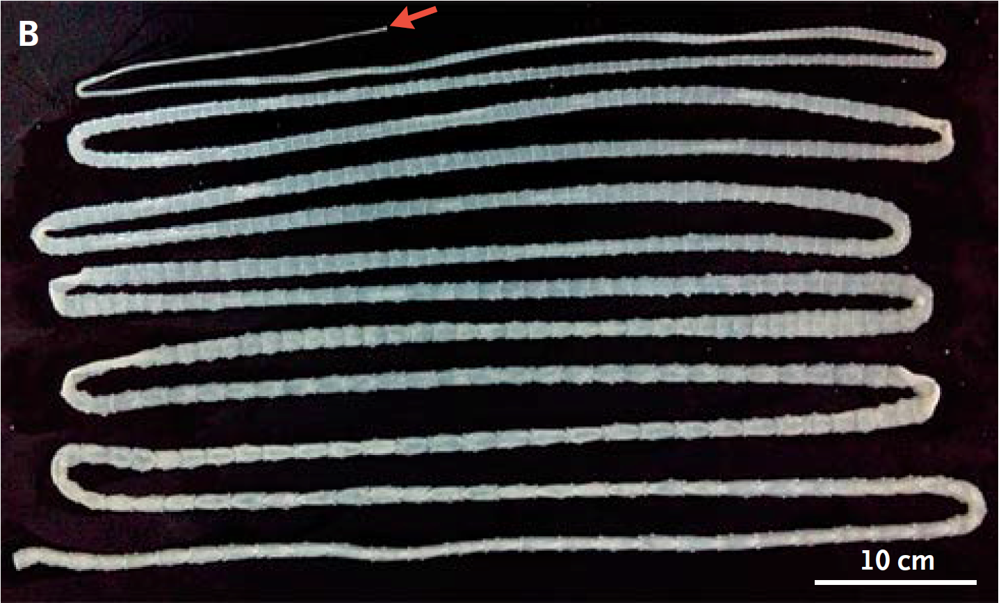 Man Gets 20-Foot Tapeworm from Eating Raw Meat | Live Science