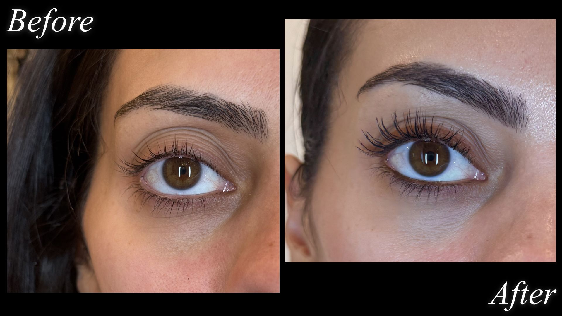 PRFM Undereye Injections: Review and Before/After Photos | Marie Claire