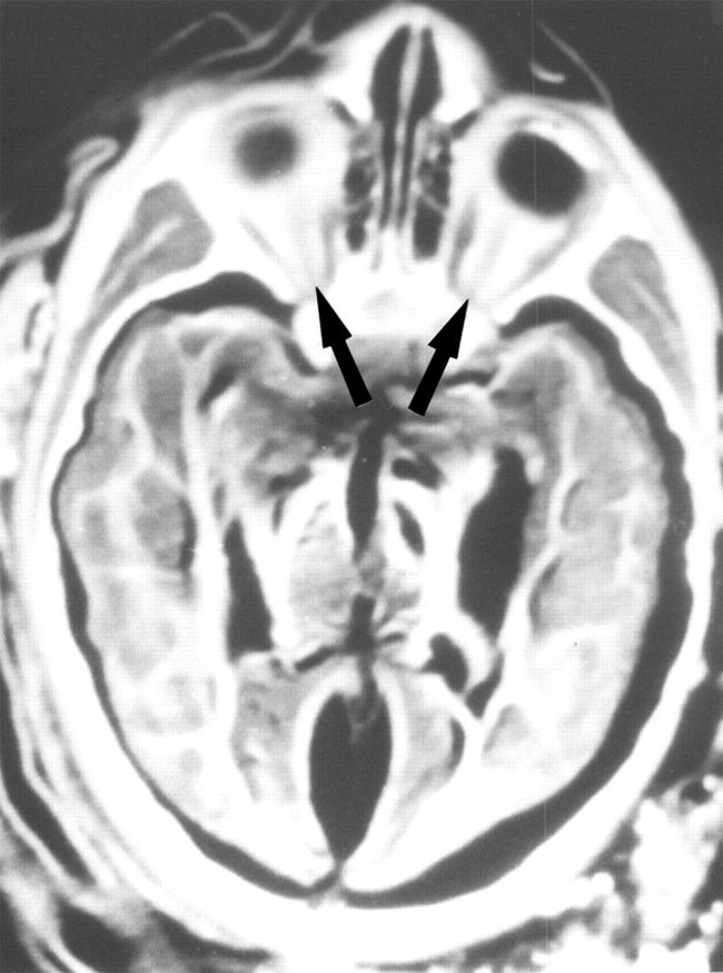 Image Gallery: Inca Child Mummies | Llullaillaco Volcano | Live Science