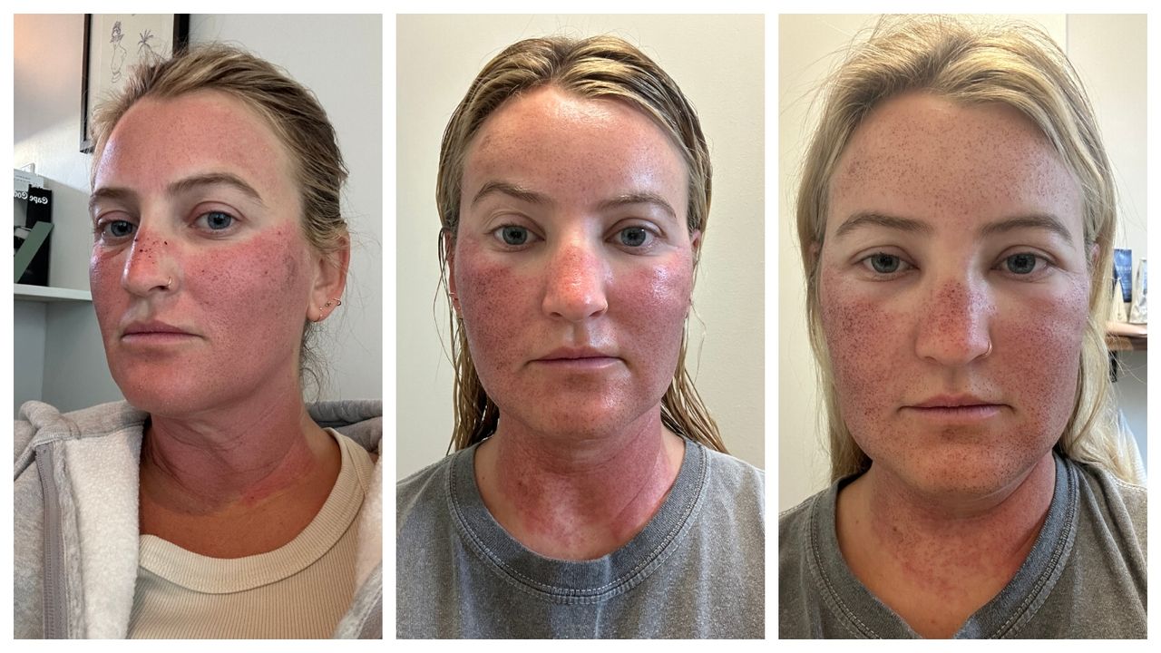 HALO Laser Review: I Tried the Treatment for Smooth, Glowy Skin | Marie ...